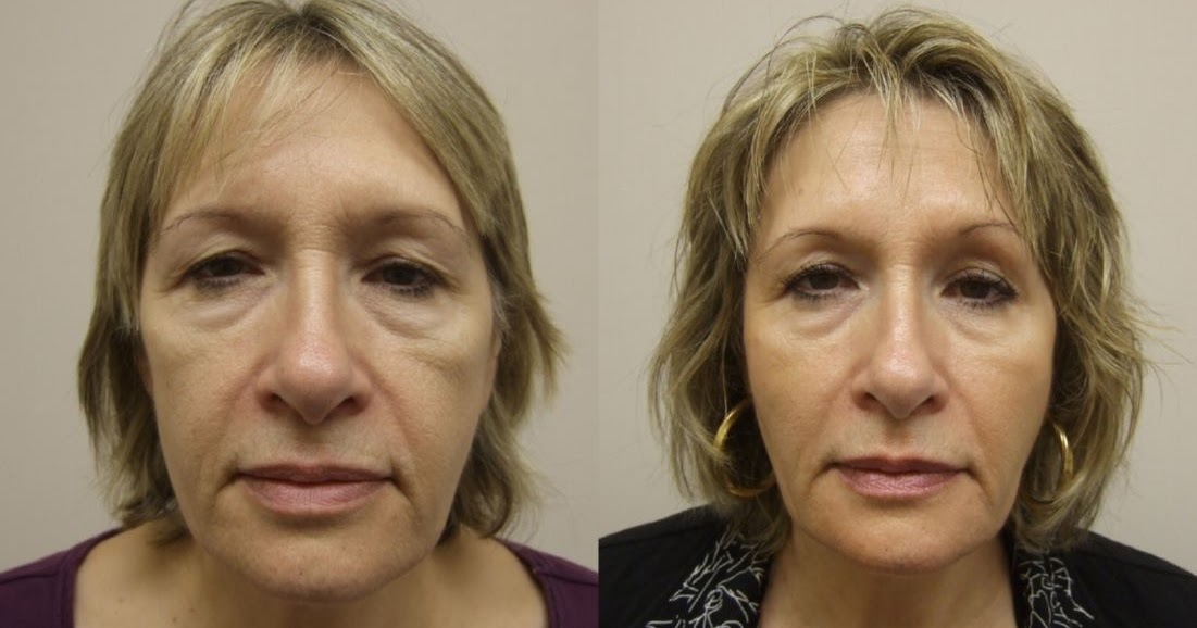 A Facial Exercise Toning Program That Results In Natural Facelifts ...