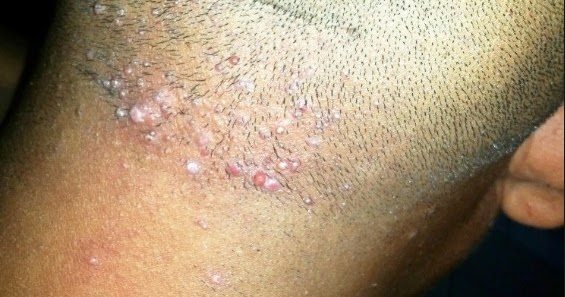 Acné en la nuca ~ Natwiki