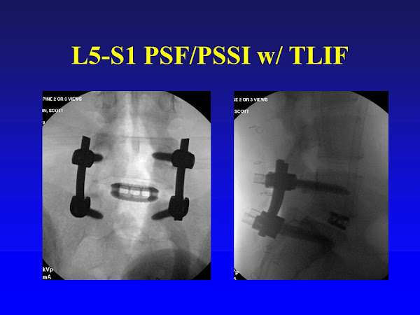 Spondylolysis/Pars Fracture: Surgical Treatment Part 6 | Growing Spine ...