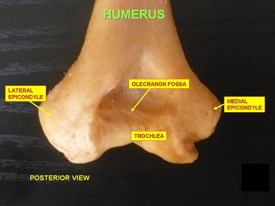 Supracondylar fracture of Humerus
