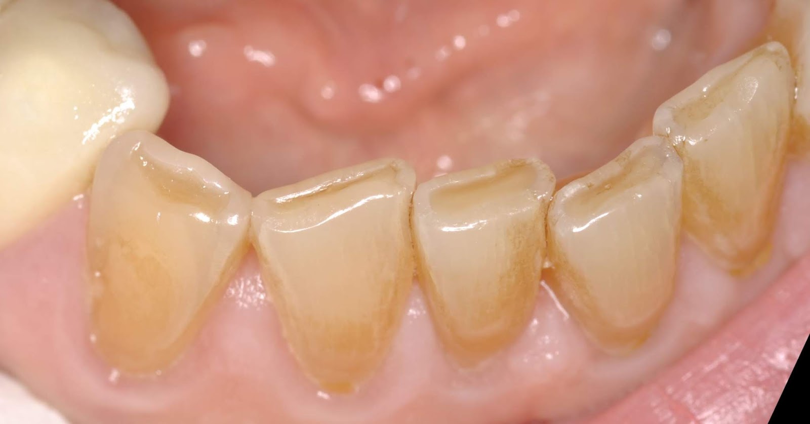 Ask Dr. Spindel: What are cupping lesions and how should dentists ...