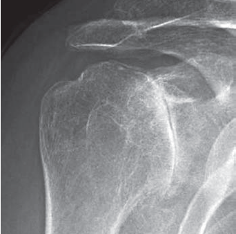 UW Shoulder and Elbow Academy: Humeral head osteotomy in shoulder ...