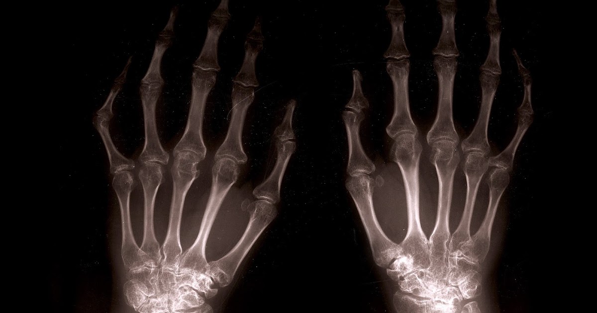 Fald og frakturer: Fraktur