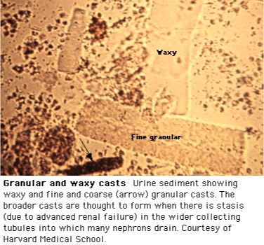 USMLE COMLEX Study Guides : Renal Pathology: Glomerular Diseases