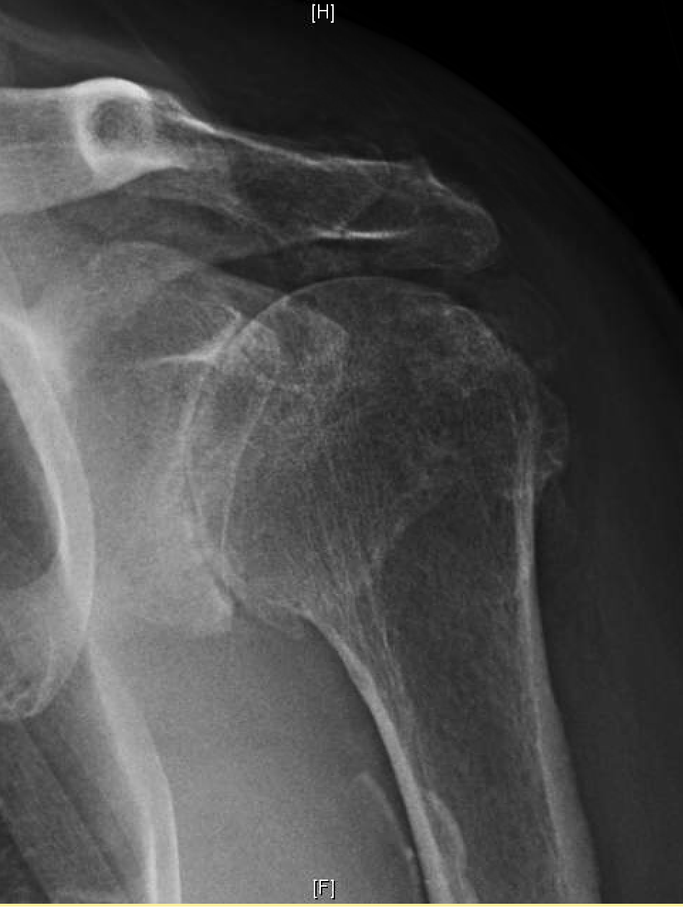 UW Shoulder and Elbow Academy: B2 retroverted glenoid => total shoulder ...