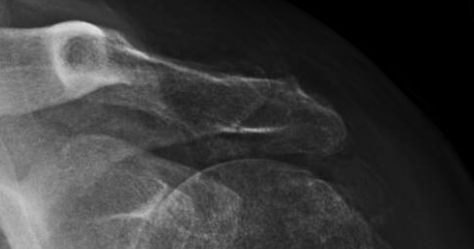 UW Shoulder and Elbow Academy: B2 retroverted glenoid => total shoulder ...