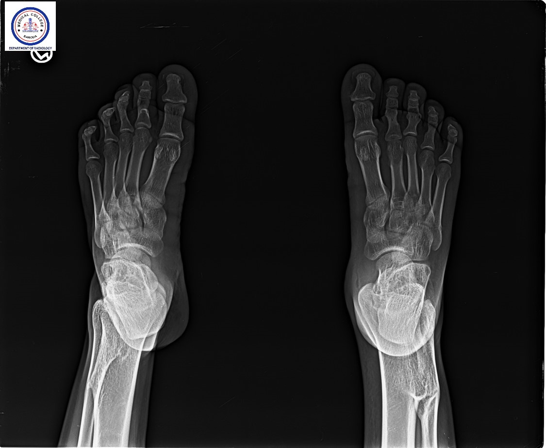 HEREDITARY MULTIPLE EXOSTOSIS