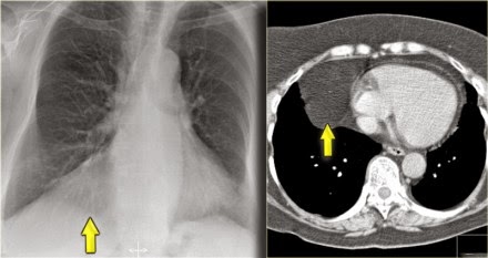 Chest Medicine Made Easy-Dr Deepu: BASICS OF CHEST X RAY-PART 4, THE ...