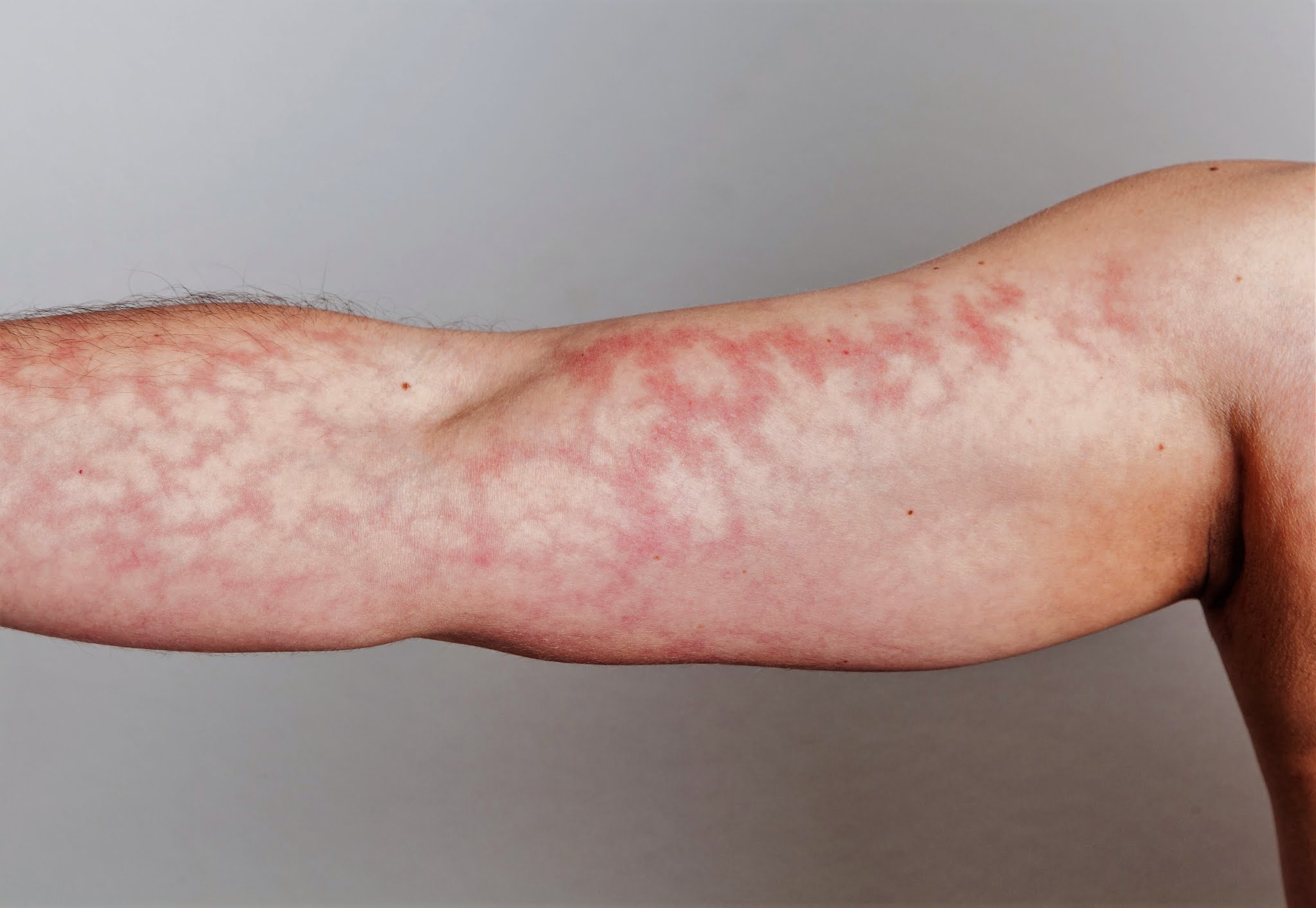 The Mottled skin | treatment | causes | symptoms