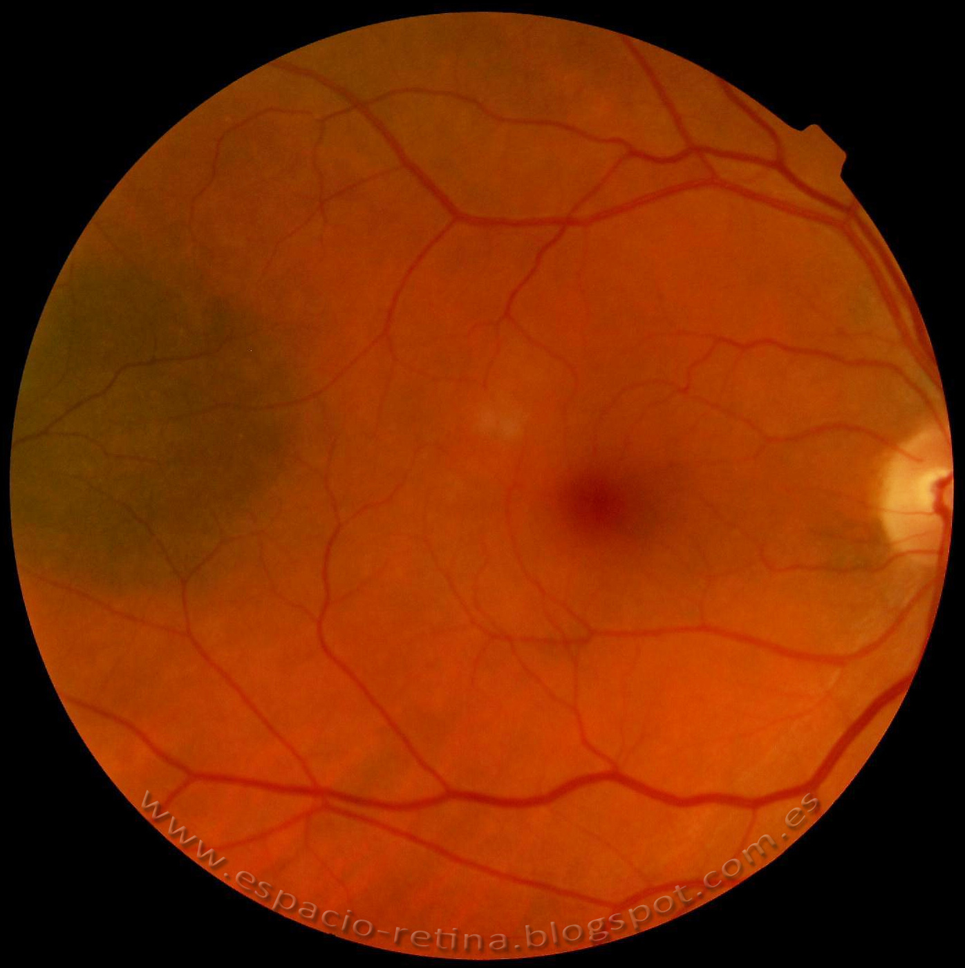 ESPACIO RETINA: Nevus.