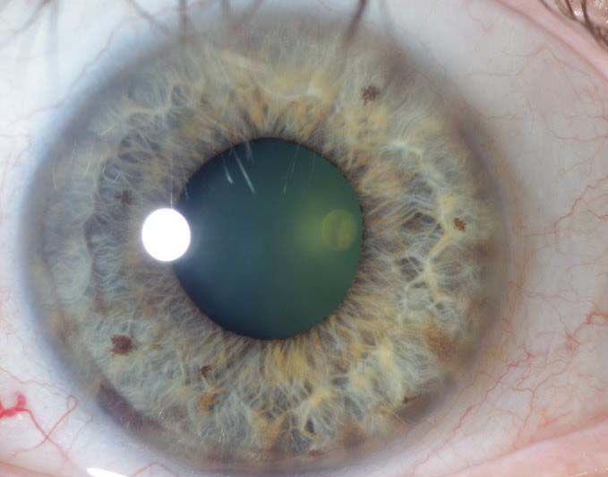 Modern & Multidimensional Iridology: Iris Pigments at Different Iris ...