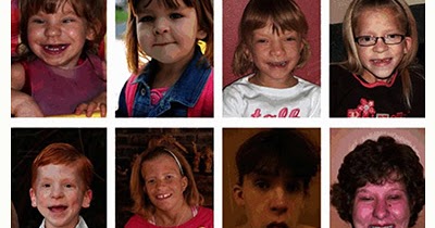 pediatric neurology: Epilepsy in Koolen-de Vries syndrome