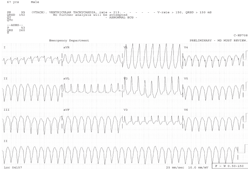My Variables Only Have 6 Letters: EKG Myth - Ventricular tachycardia ...