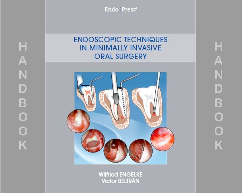 HANDBOOK: Endoscopic Techniques in Minimally Invasive Oral Surgery ...