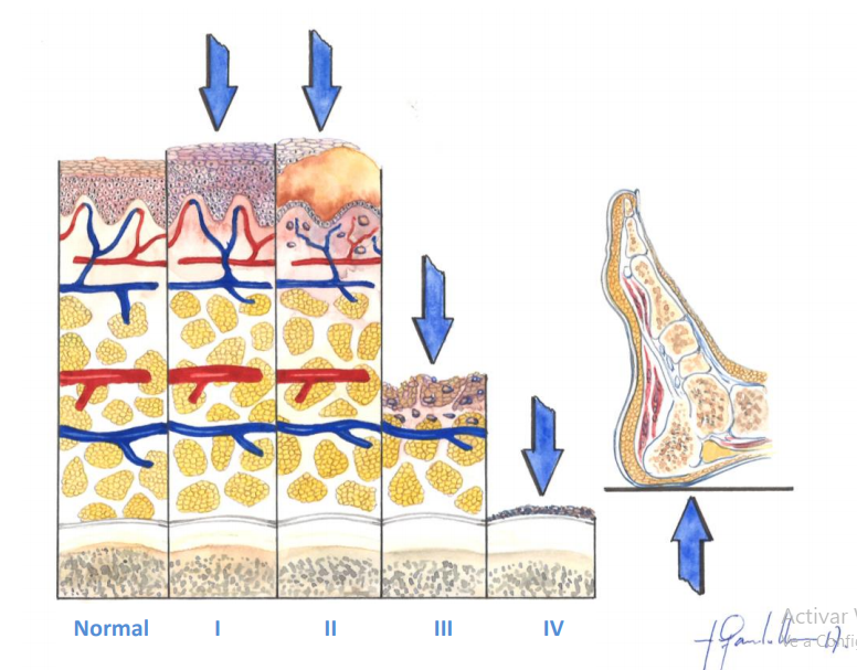 3. PREVENCIÓN Y TRATAMIENTO DE LAS ÚLCERAS POR PRESIÓN