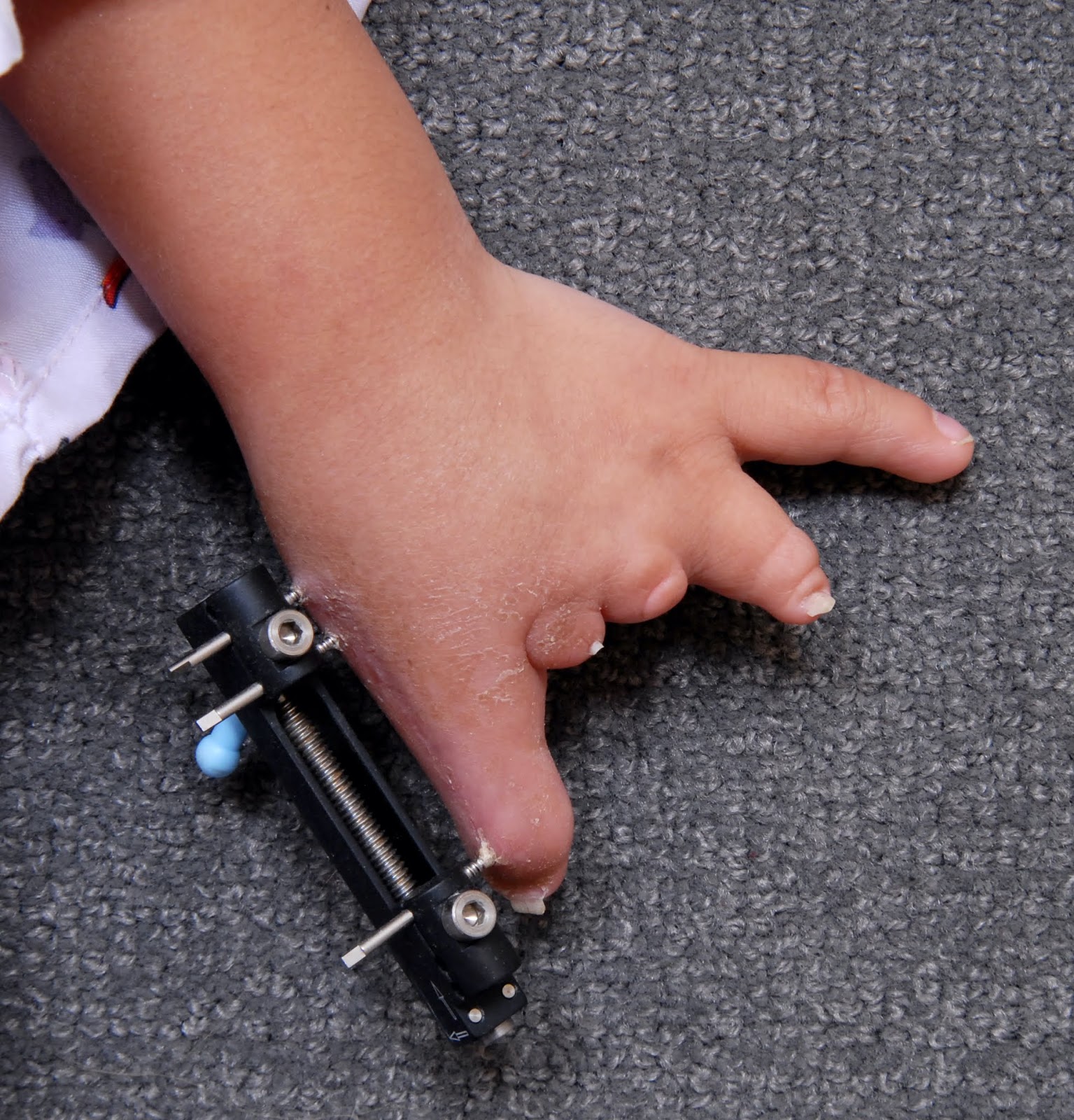 Amniotic Constriction Band- how we can help function | Congenital Hand ...