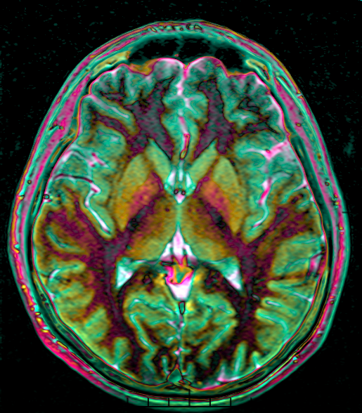 MRI With Contrast