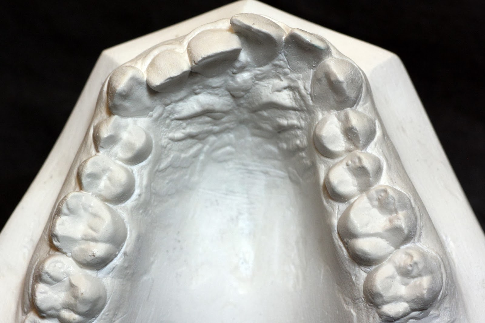 Orthodontics: UG Model Analysis Position of teeth