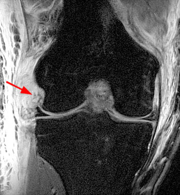 Radiology Pearls: Knee dislocation