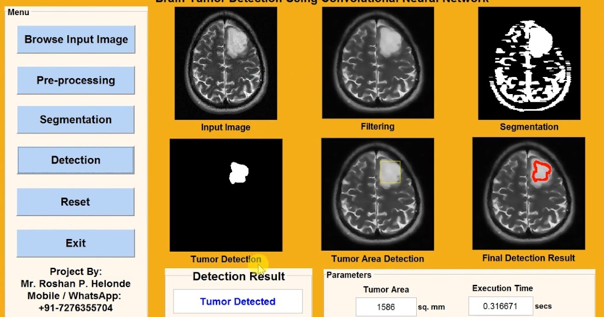 Brain Tumor Detection Using Cnn Convolutional Neural Network Matlab Project Source Code ~ Matlab