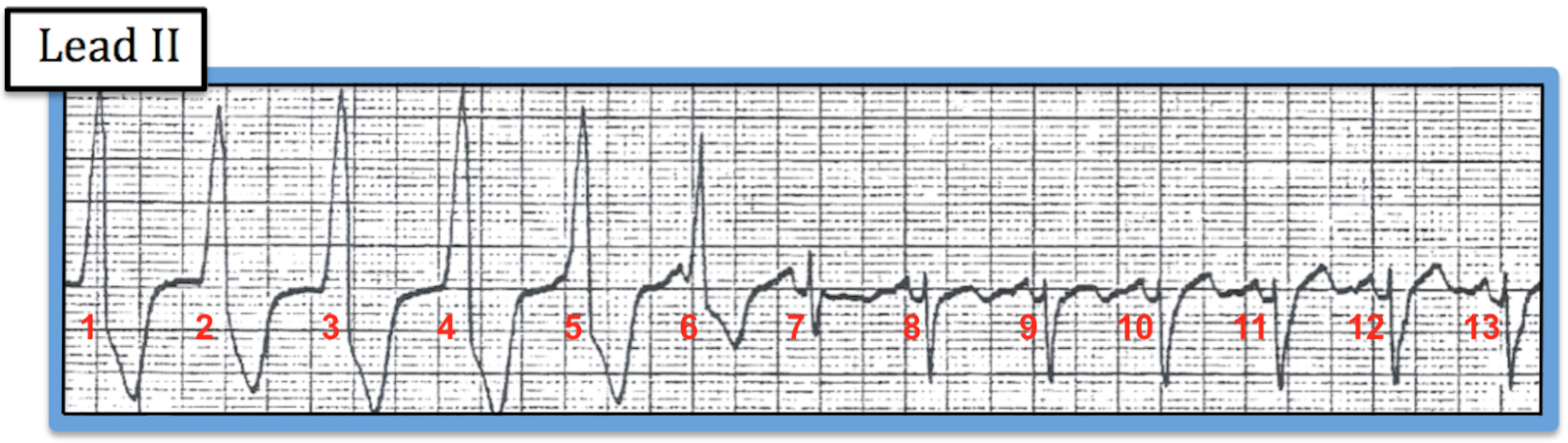 ECG Interpretation: ECG Blog #128 — VT, Fusion, WCT, Sinus Tach