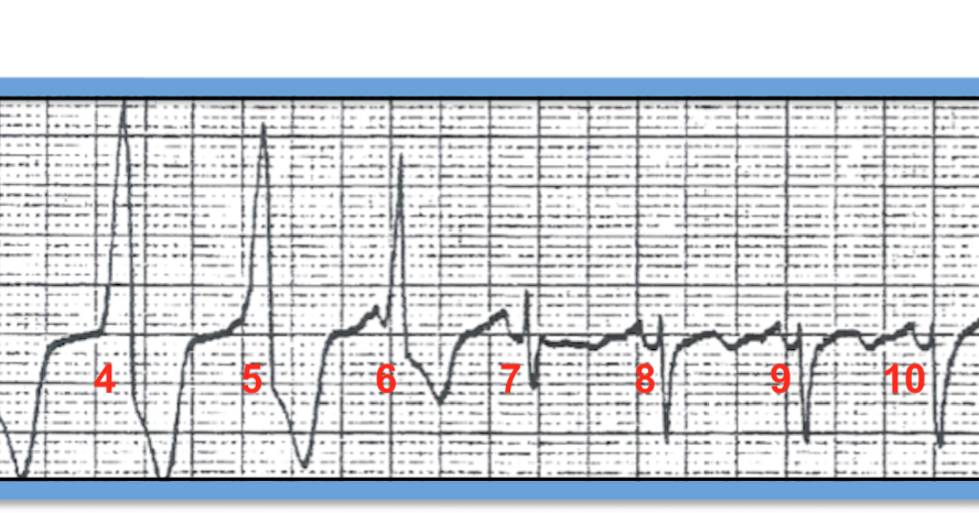 ECG Interpretation: ECG Blog #128 — VT, Fusion, WCT, Sinus Tach