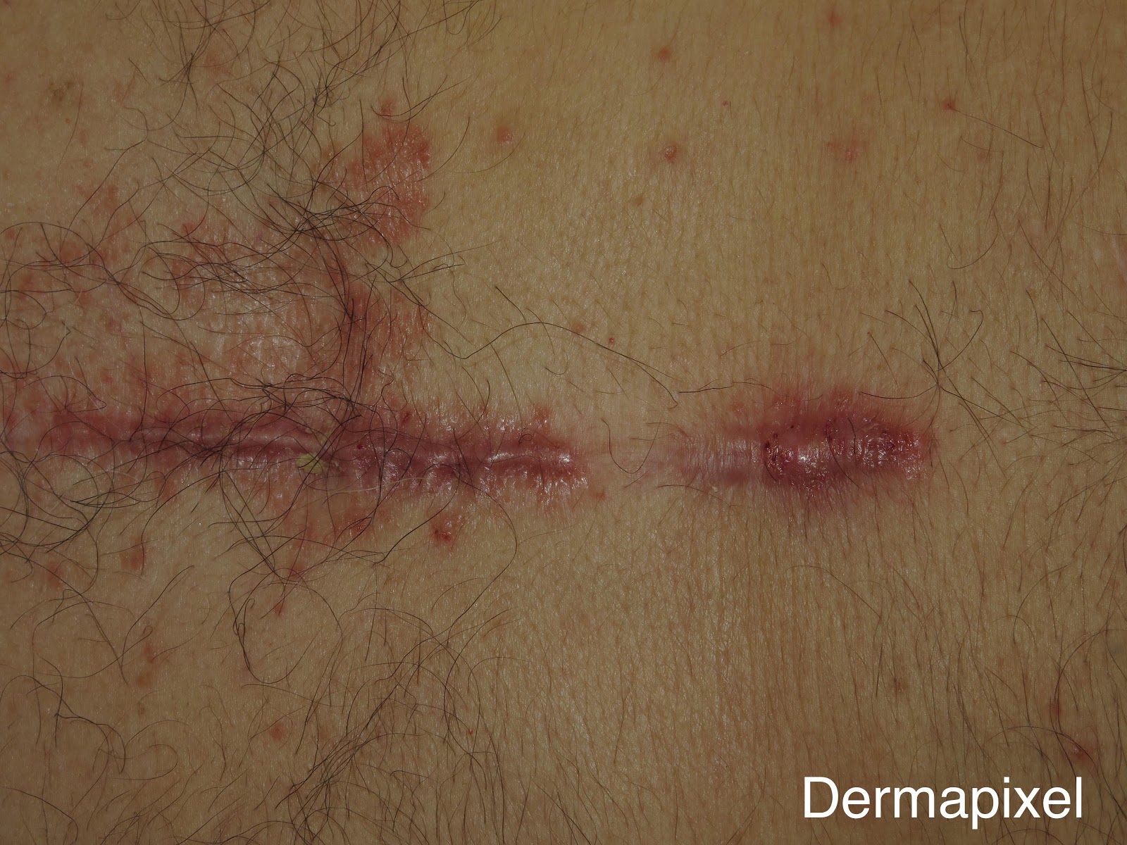 Dermapixel: junio 2018