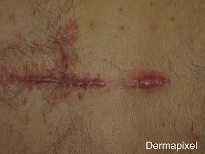 Dermapixel: junio 2018