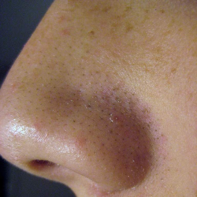 Cara Menghilangkan Komedo Di Hidung Dan Dagu Juga Pipi Dengan Cepat Secara Alami Dan Tradisional