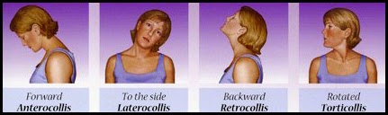 Doctor Pistachio: Cervical Dystonia