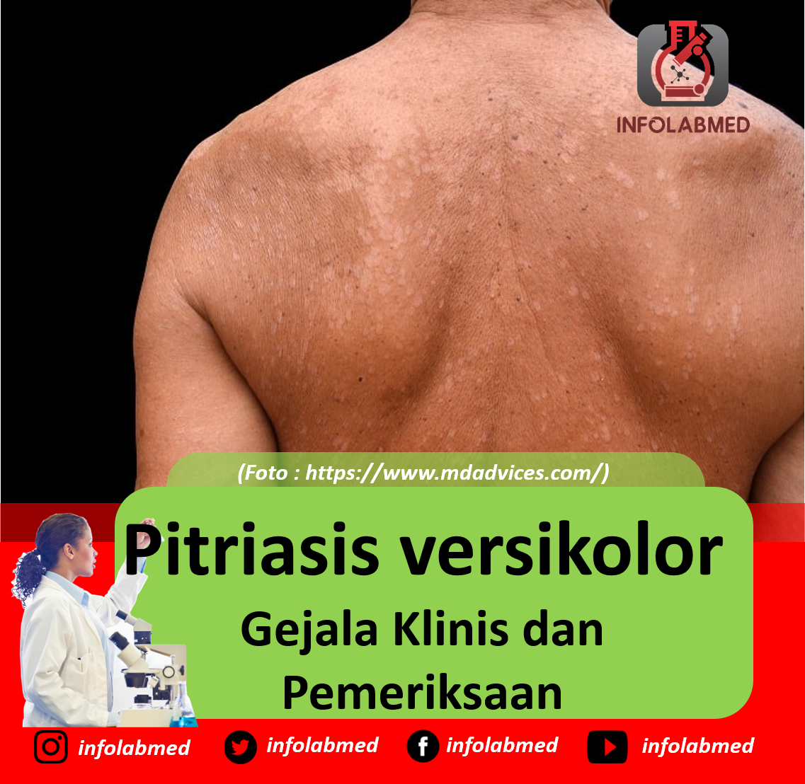 Pitriasis versikolor | Gejala Klinis dan Pemeriksaan