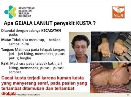 Kusta dan Paradigmanya yang Salah Kaprah - Zeneth Thobarony’s Journal