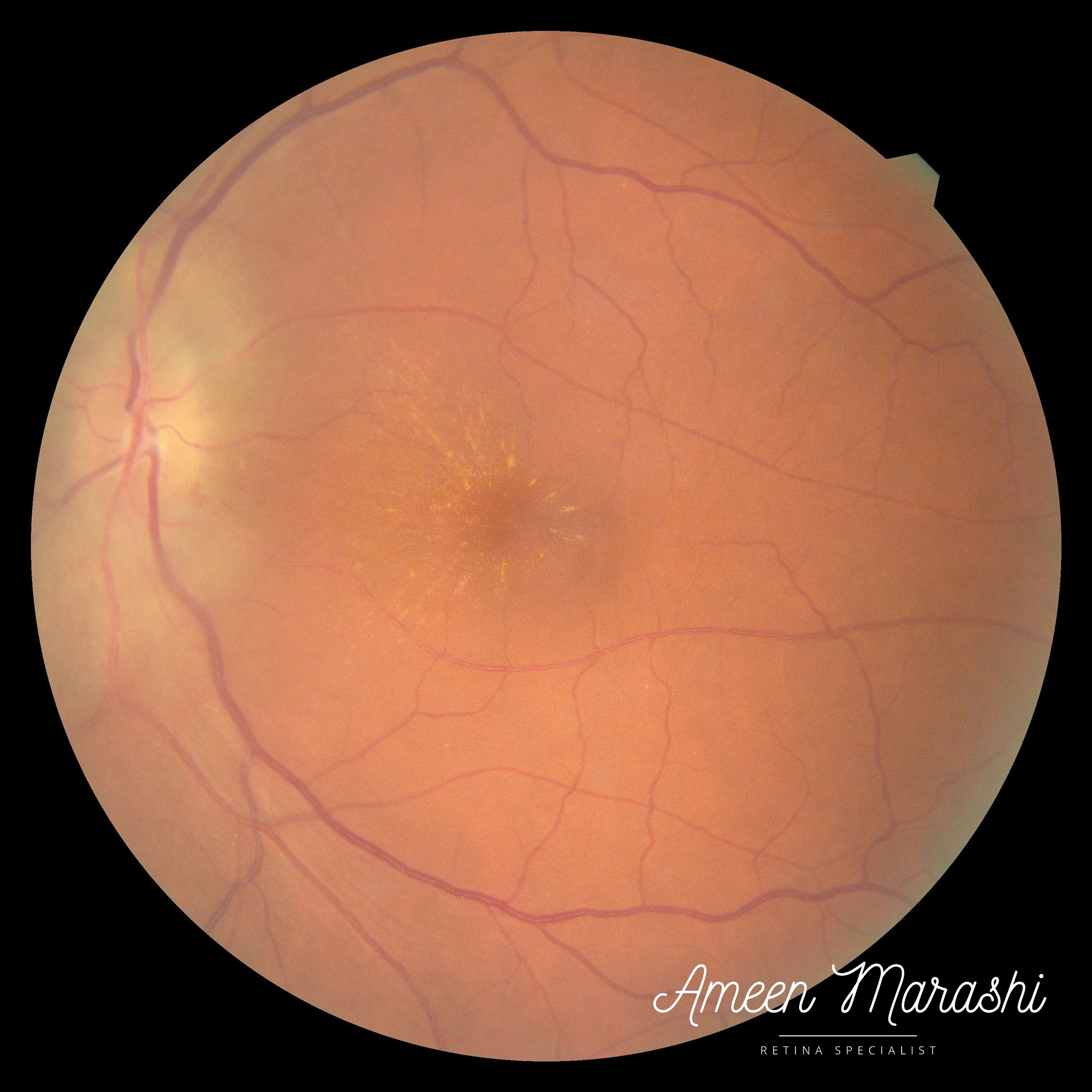 Idiopathic neuroretinitis