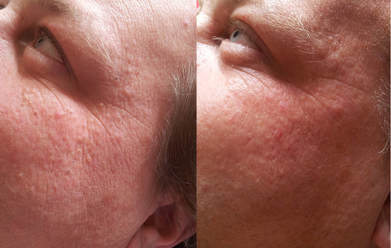 So life begins at 40 does it?: Environ Skin Peel - For Men!