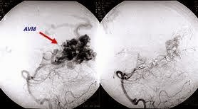 Medical Treatment Pictures-for Better Understanding: Embolization ...