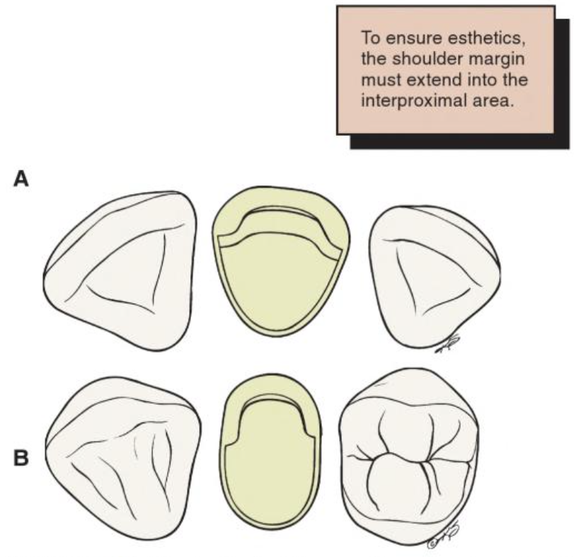 Odontology Student: Prosthodontics: The Metal-Ceramic Crown Preparation ...