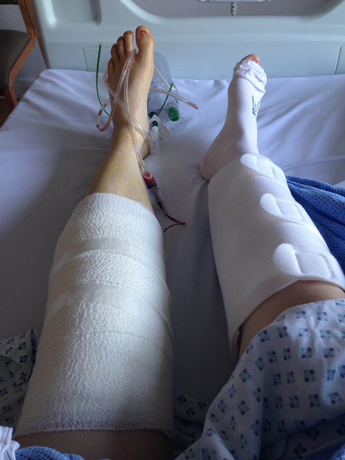 My Experience Having MPFL Reconstruction Surgery