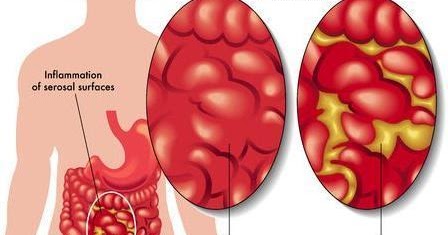 Peritonitis: Causes, Symptoms, & Treatment