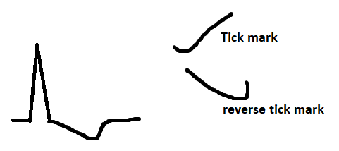 DIGOXIN ECG CHANGES DIGITALIS TOXICITY-DIGITALIS EFFECT