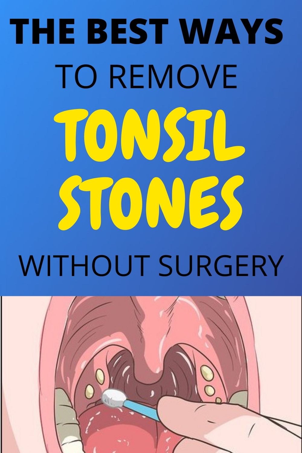 4 EFFECTIVE WAYS TO REMOVE TONSIL STONES WITHOUT SURGERY