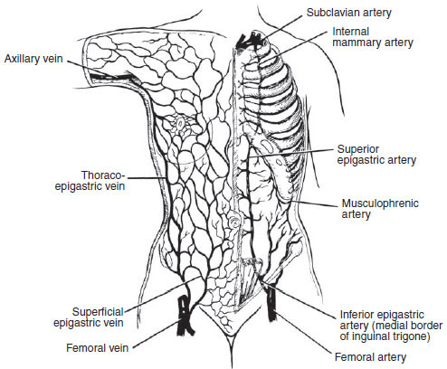 Inferior Epigastric Artery Case File