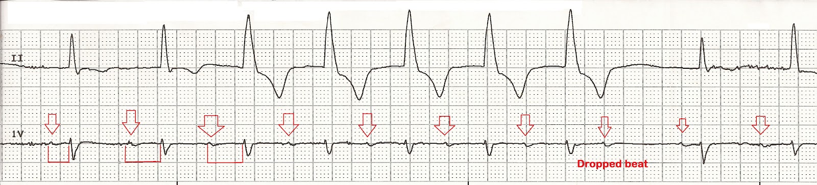 An Unusual 2nd Degree AV Block Type I