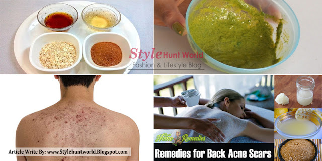 How To Get Rid Of Back Acne Naturally - Style Hunt World