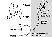Ramayya Pramila Urology Hospital: LAPAROSCOPIC NEPHRO-URETERECTOMY FOR ...