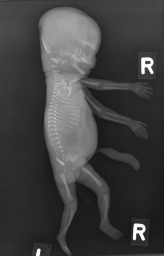 Teknik Radiografi: Teknik Radiografi Babygram