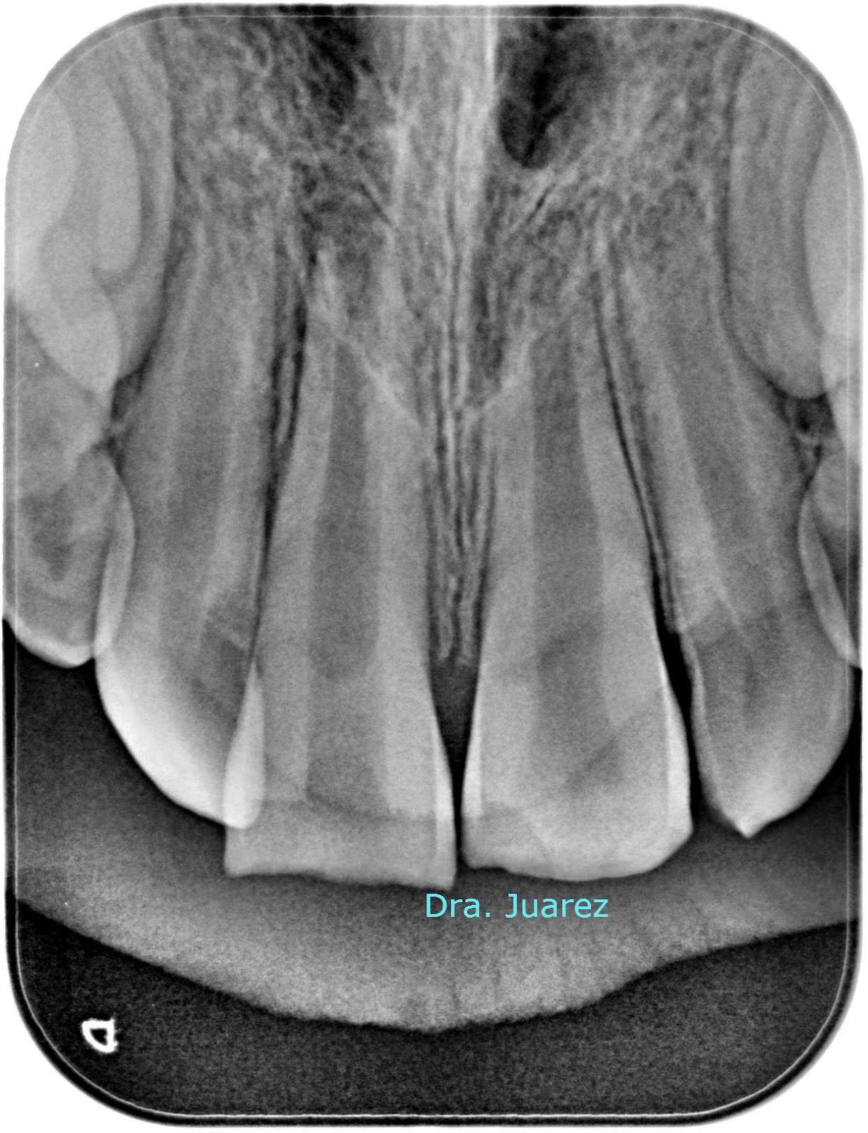 endodonciamississippi: Apicoformacion Diente anterior joven por la Dra ...