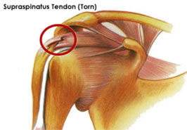 Tendinitis Supraspinatus