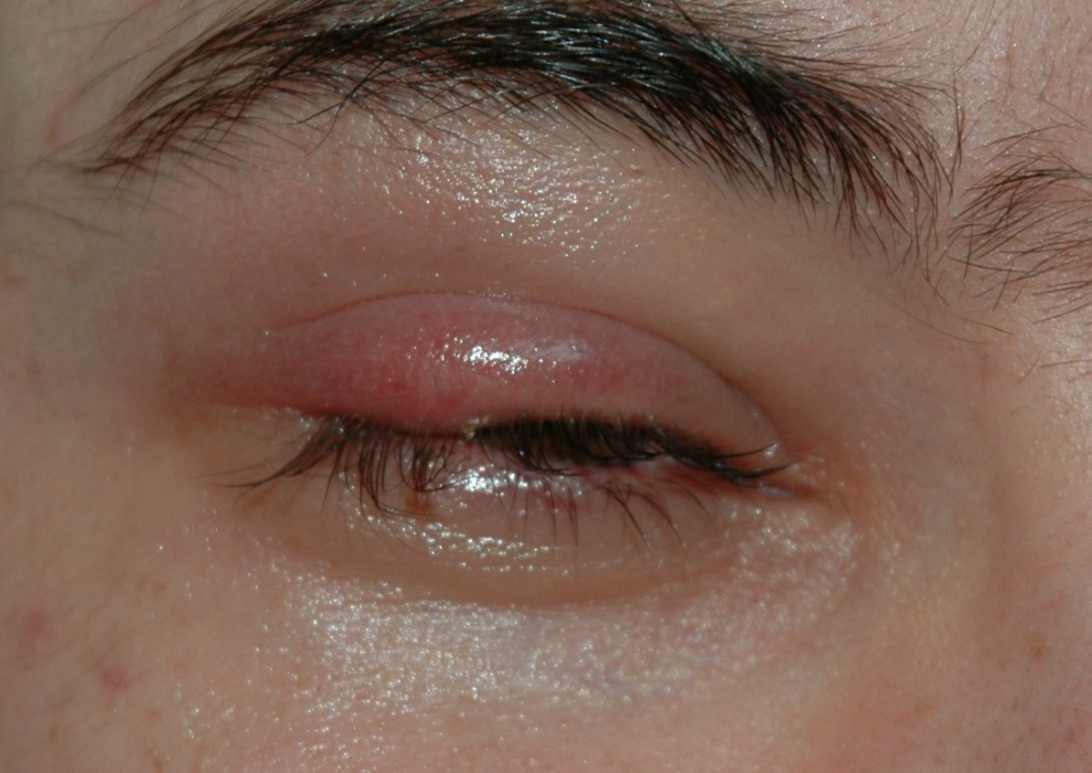 Photos For Hordeolum - Stye ~ YOUNG DOCTORS' RESEARCH FORUM