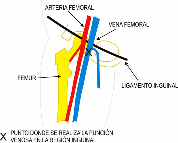 El Blog De la Enfermera: Acceso Arterial pt 2