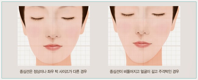 Memperbaiki wajah asimetris dari bagian tengah